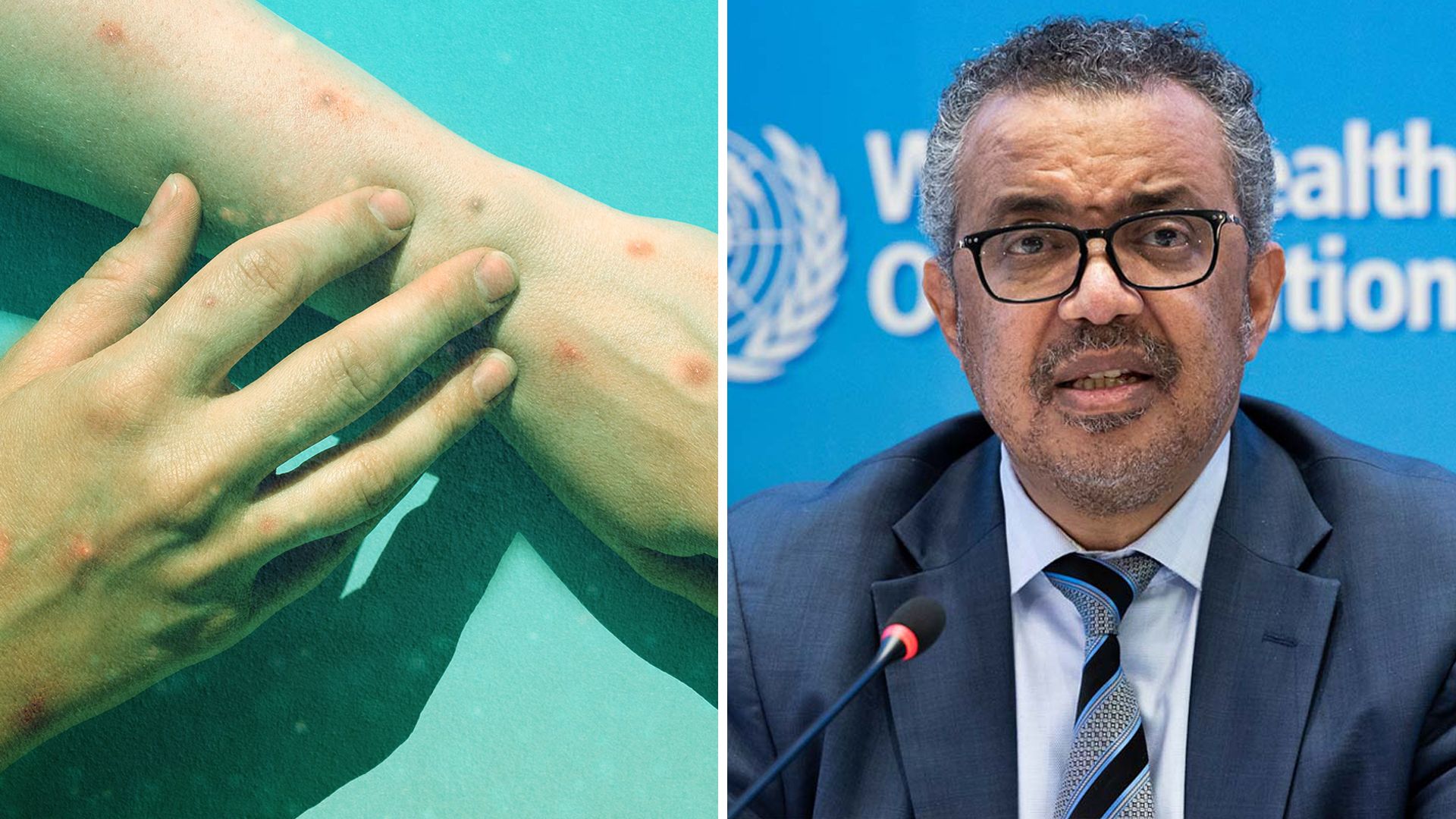 WHO utlyser globalt hälsonödläge med anledning av apkoppor