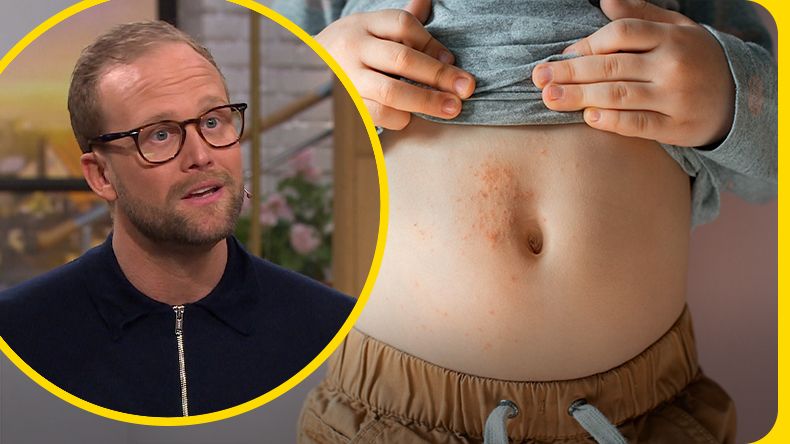 Så gör du om ditt barn fått skabb