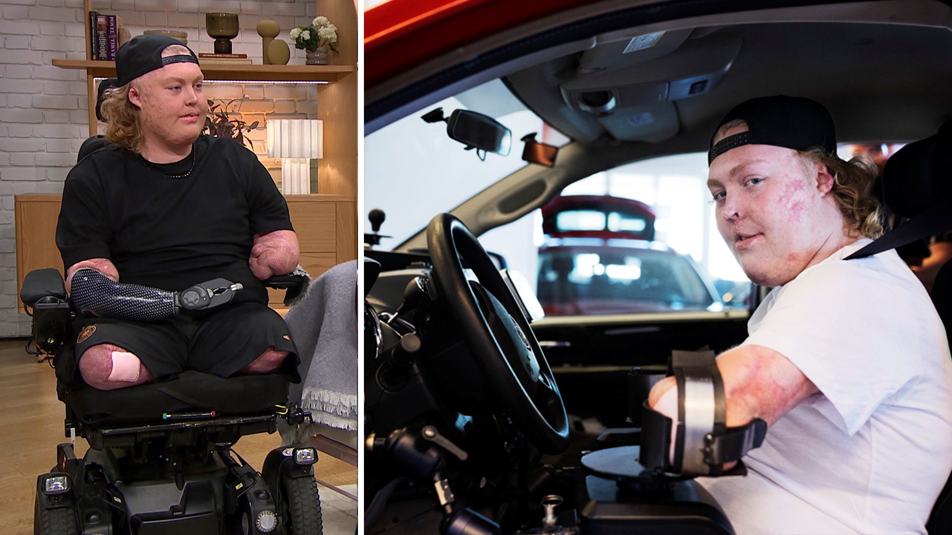 18-årige Viktor förlorade armar och ben i efter sepsis