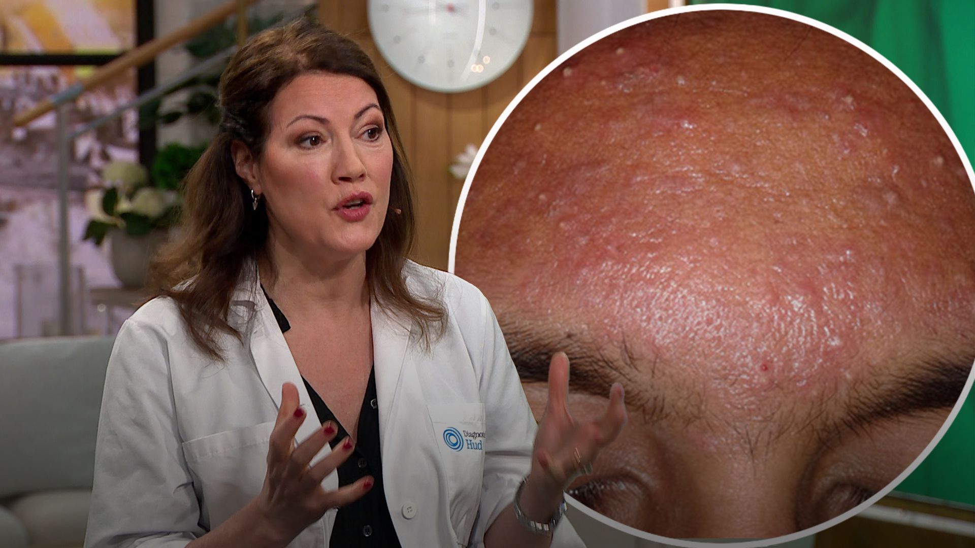 Egenbehandling eller medicin? – så behandlar du din akne